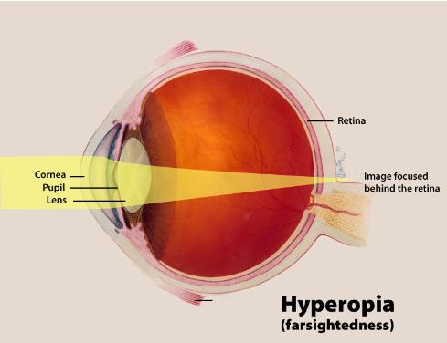 Longsightedness (Hyperopia) - Symptoms and treatments for ...